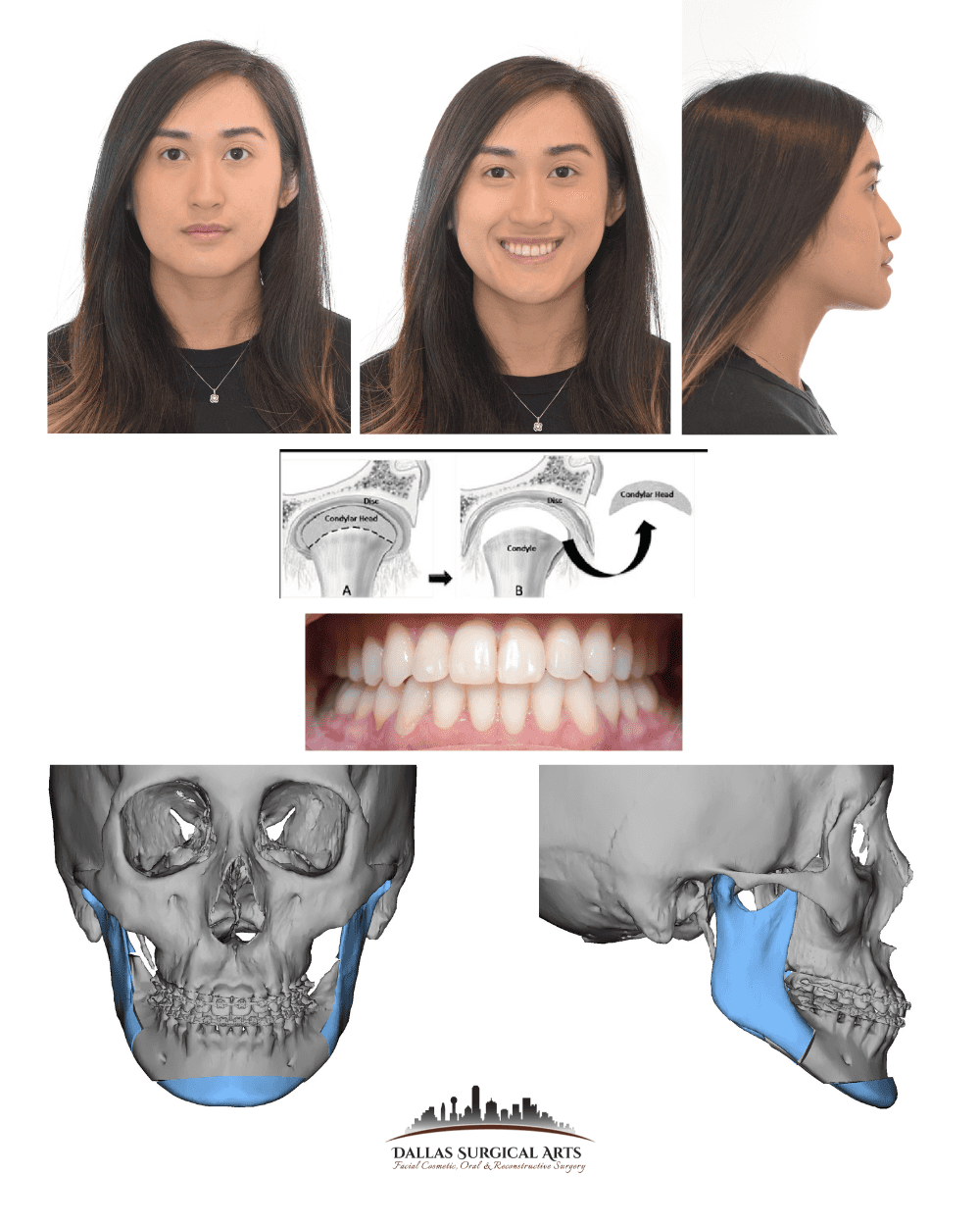 Jaw Repositioning (Orthognathic Surgery) | Dallas Surgical Arts